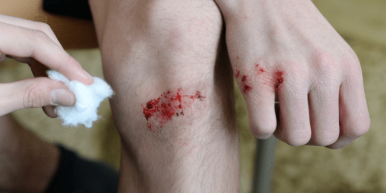 Signs of Poor Wound Healing | Invigor Medical